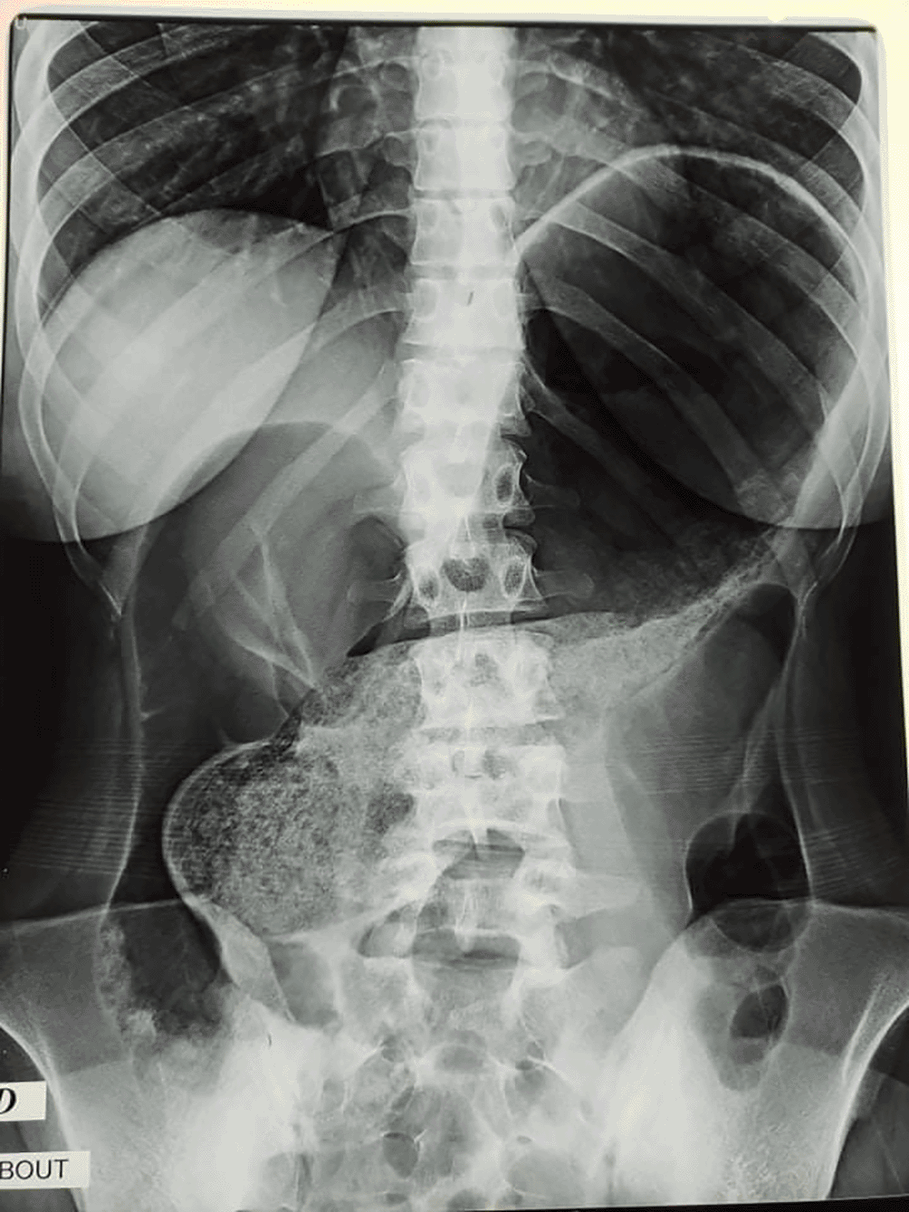 Case Report: Caecal volvulus management from... | F1000Research