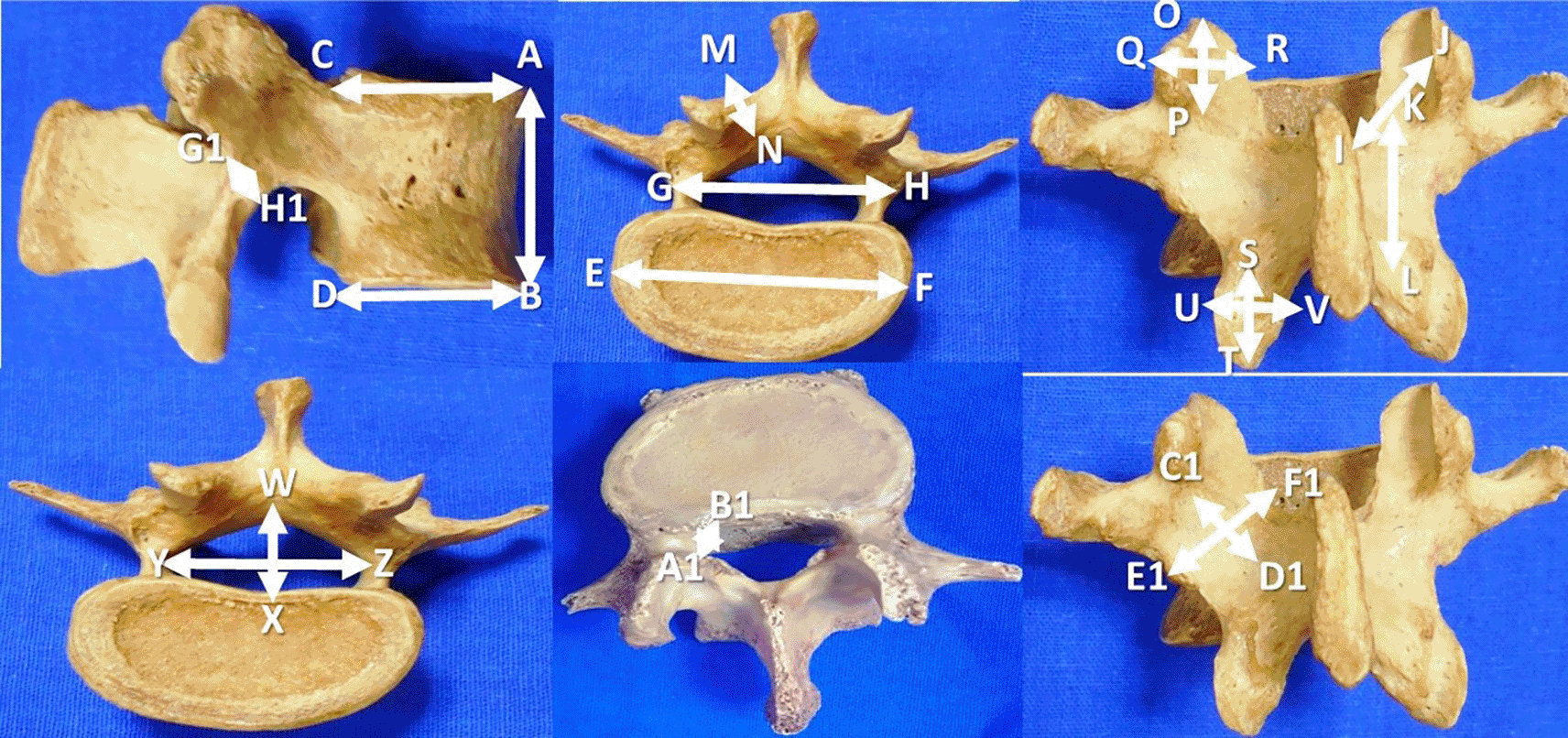 Morphometric study of the lumbar vertebrae in dried... | F1000Research