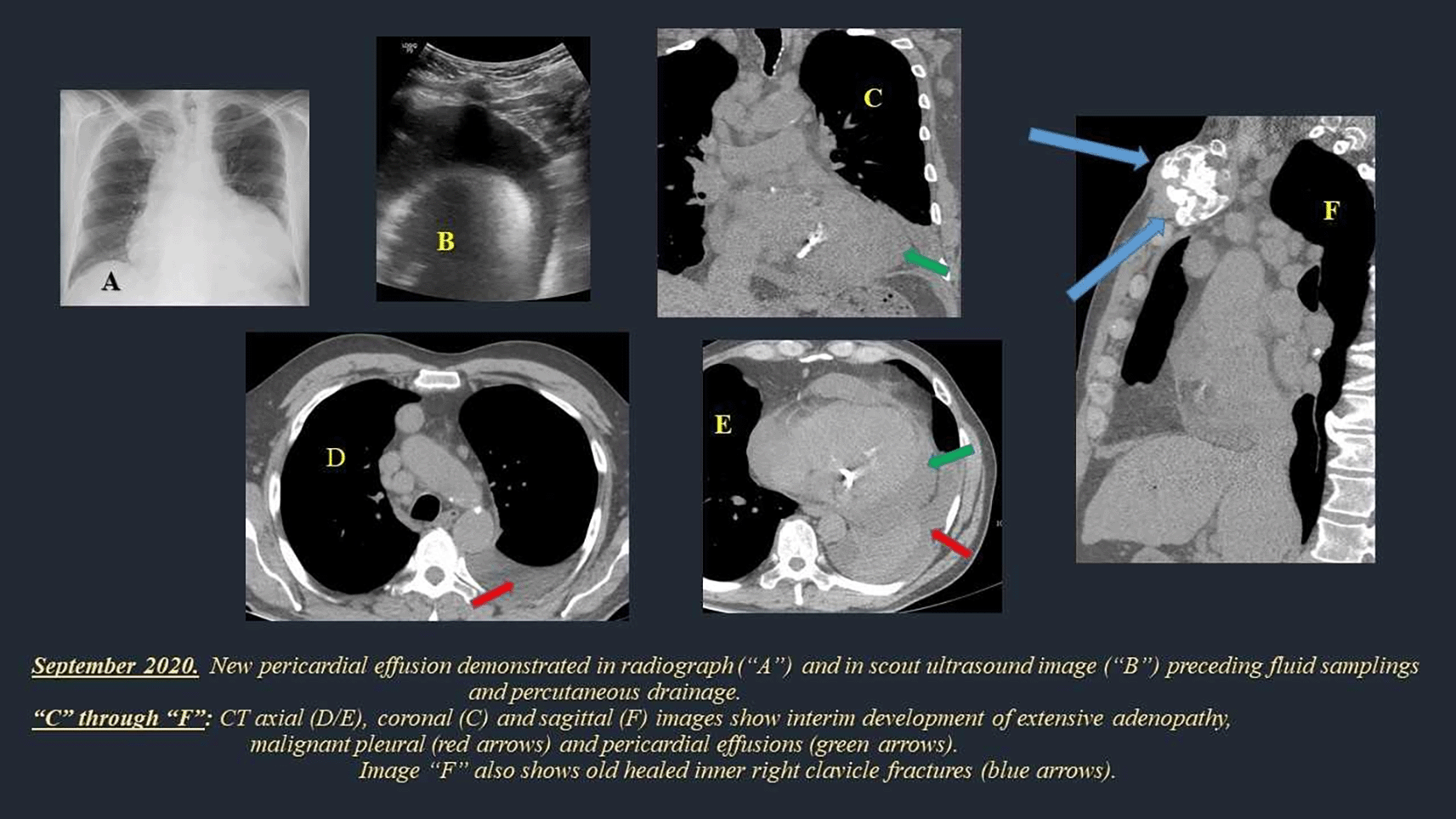 Case Report: A pericardial effusion secondary to... | F1000Research