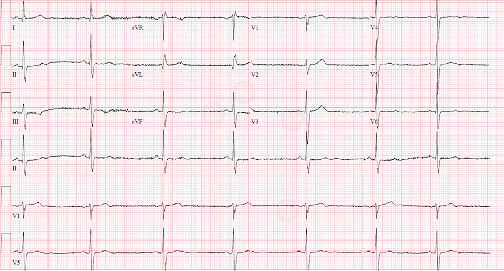 Case Report: A rare case of symptomatic bradycardia... | F1000Research