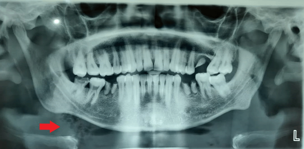 Case Report: Ludwig's angina - 'The Dangerous... | F1000Research