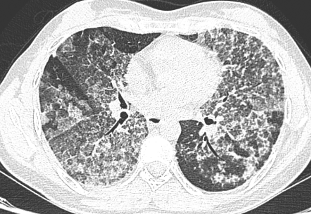 Case Report: The first reported case of pulmonary... | F1000Research