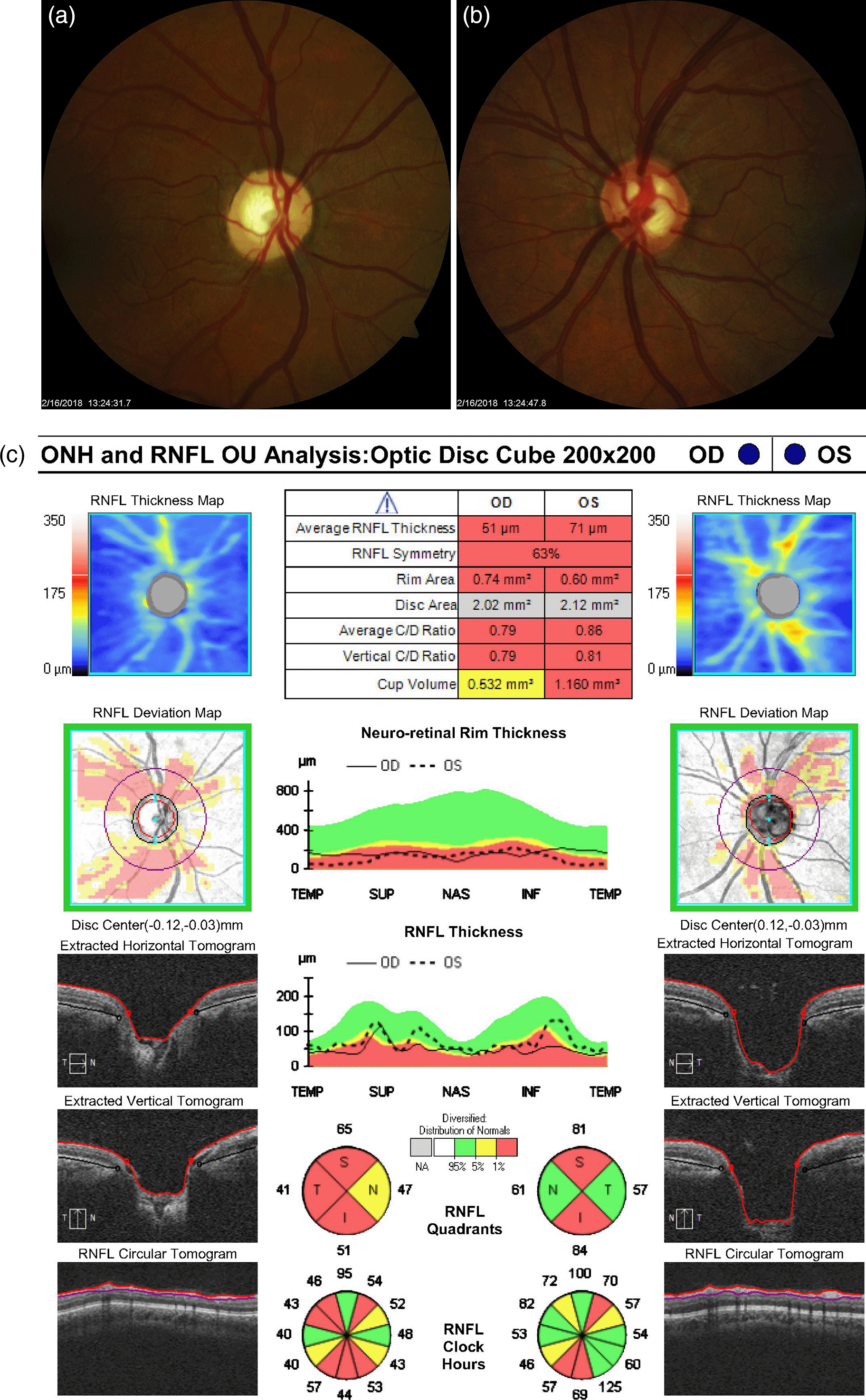 Case Report: Reversal and subsequent return of... | F1000Research