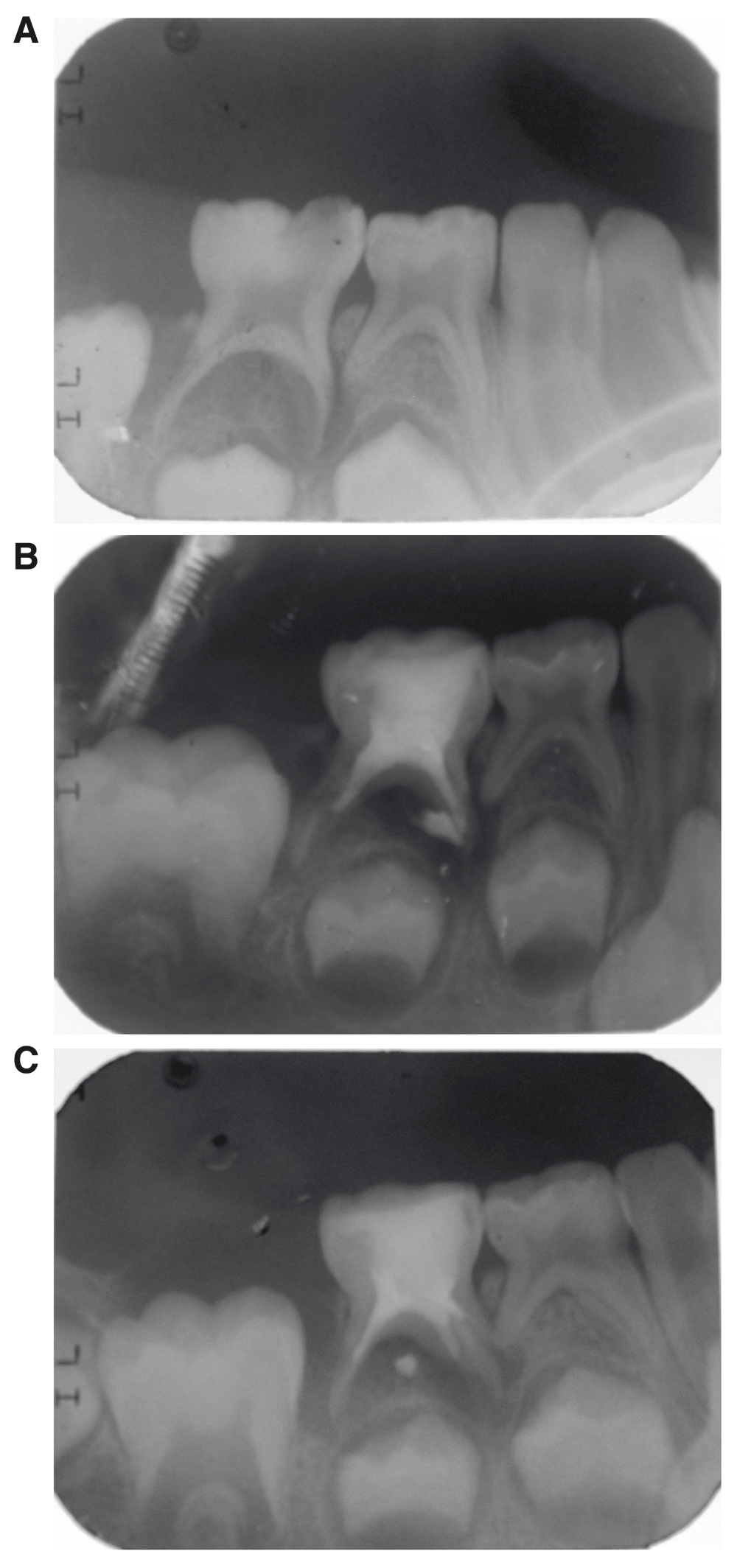 Case Report: Root resorption caused after pulp... | F1000Research