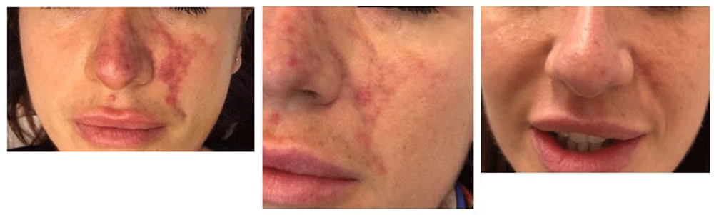 Early hyaluronidase use in preventing skin necrosis... | F1000Research