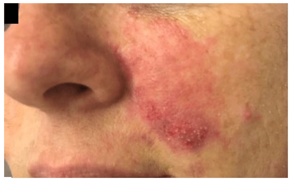 Early hyaluronidase use in preventing skin necrosis after treatment ...