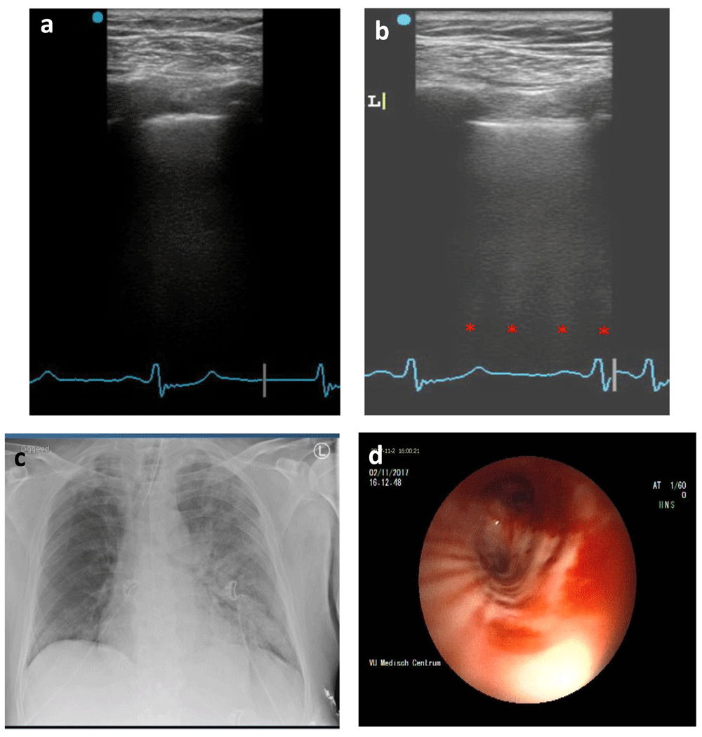Case Report: Case report: Pulmonary hemorrhage as a... | F1000Research