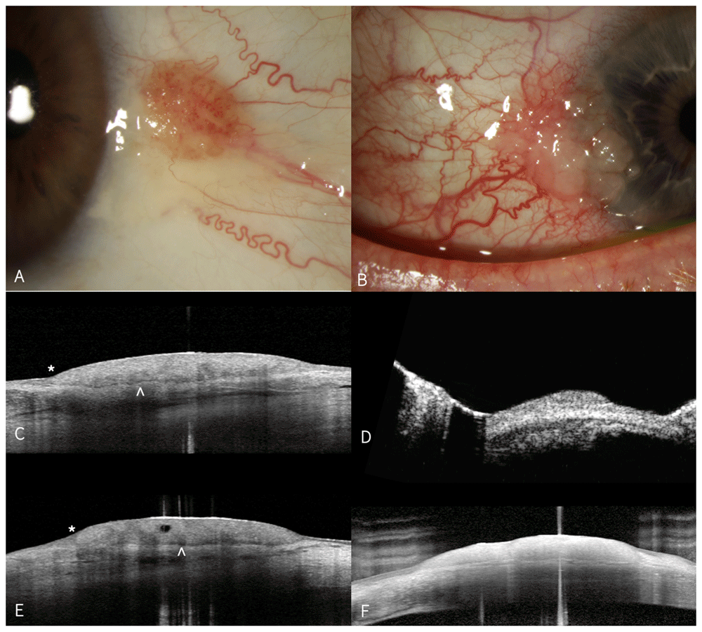 Updates in imaging in ocular oncology | F1000Research