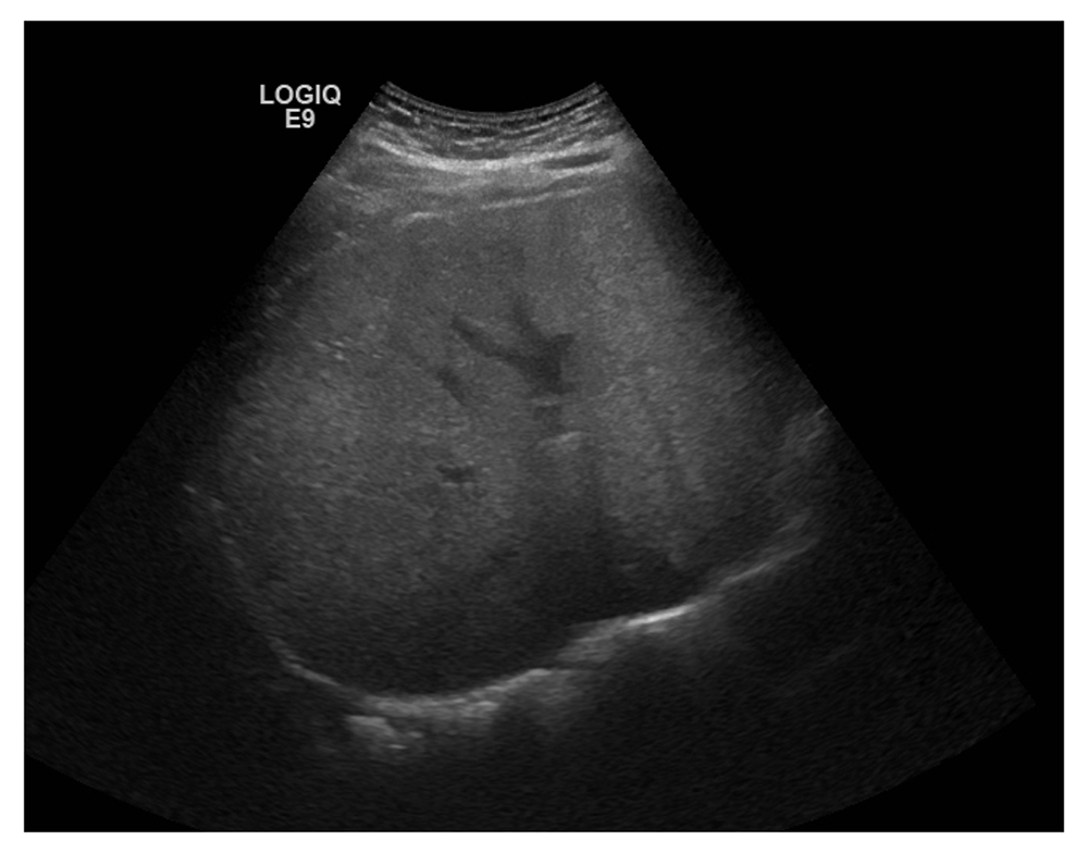 Case Report: A rare case of BCGitis in a patient... | F1000Research