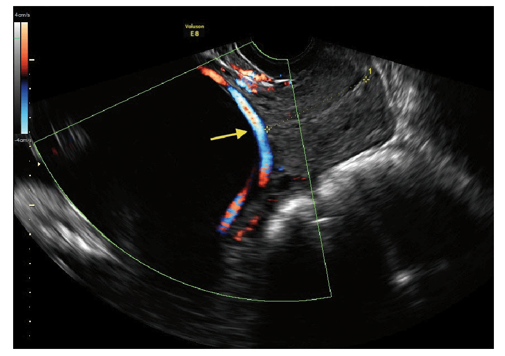 Inverted Y Perineal Incision Deepened Through