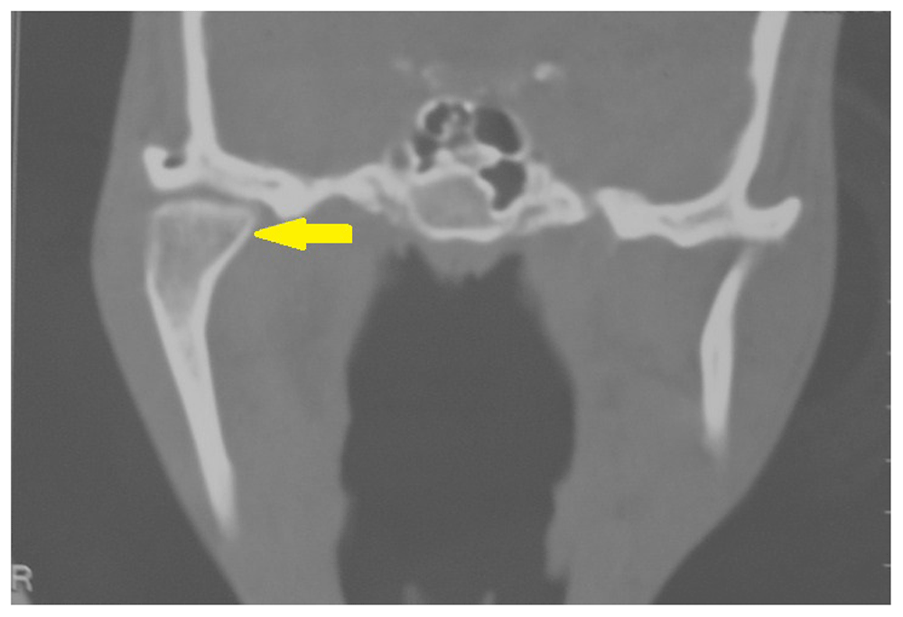 Case Report: unilateral condylar hyperplasia | F1000Research