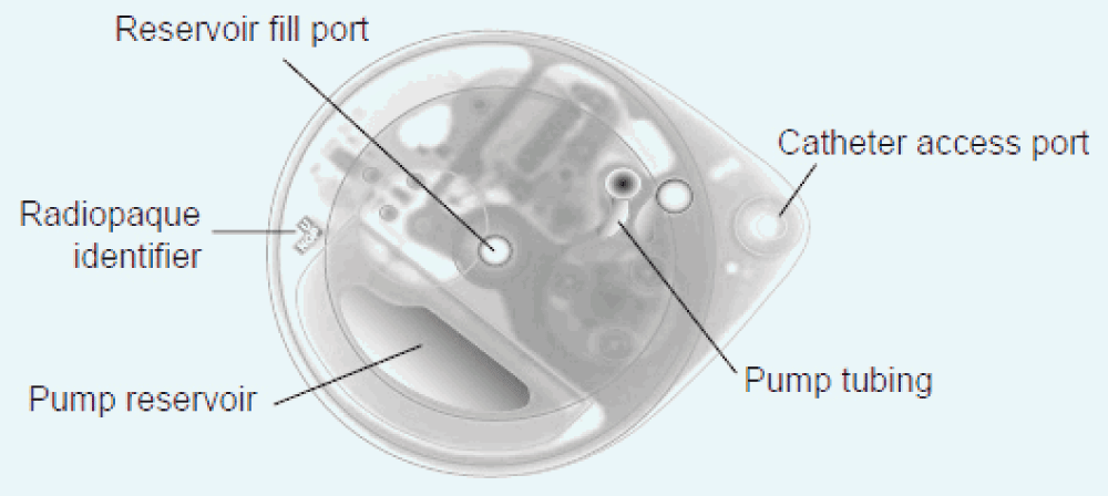 Intrathecal Drug Delivery (ITDD) systems for cancer... | F1000Research