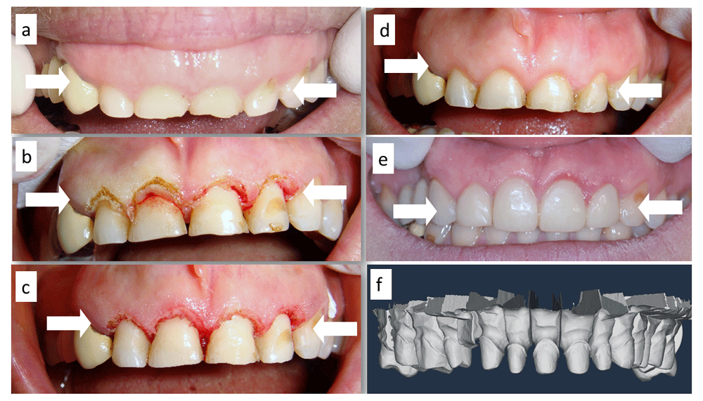 Minimally invasive (flapless) crown lengthening... | F1000Research