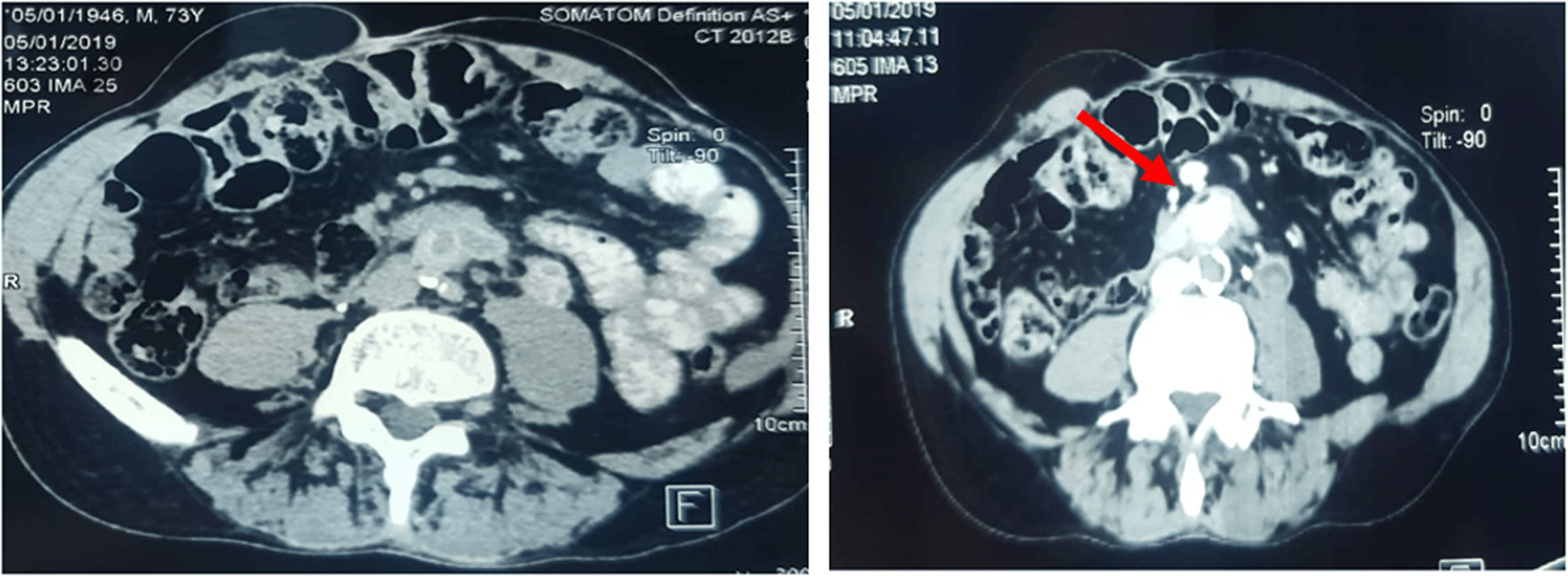 Case Report: Duodenoscopy diagnosis of a... | F1000Research