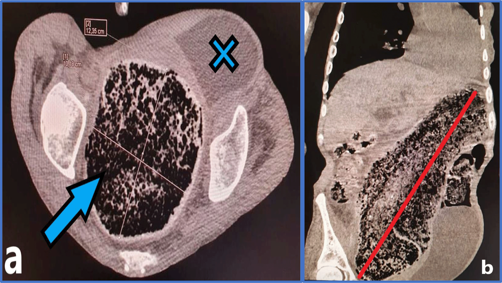 Case Report: A giant fecaloma revealed by severe... | F1000Research