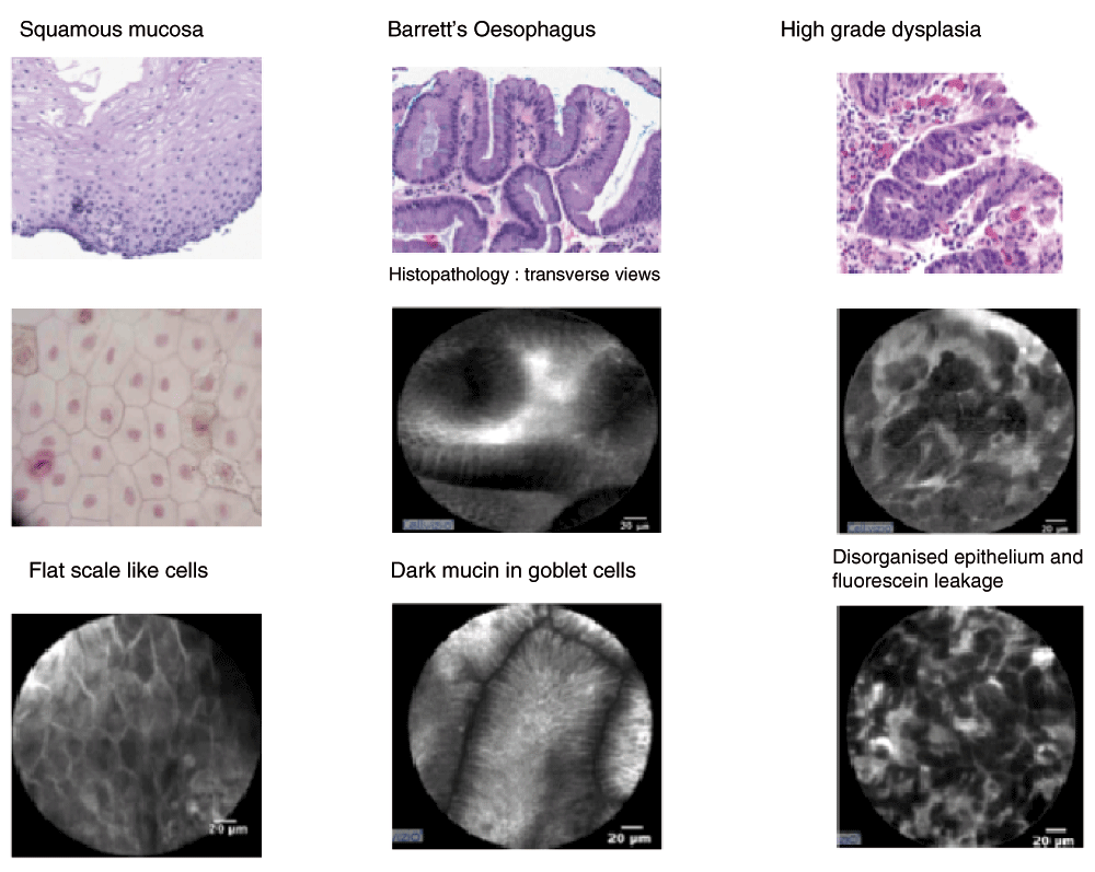 Endoscopy Abnormal Cells