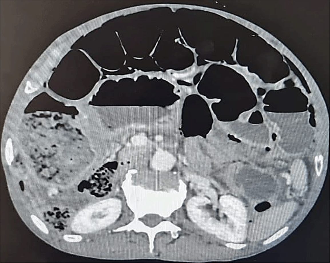 Case Report: An unusual case of small bowel... | F1000Research