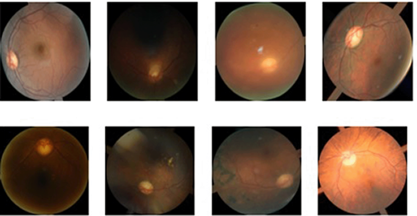 Encoding Retina Image to Words using Ensemble of... | F1000Research
