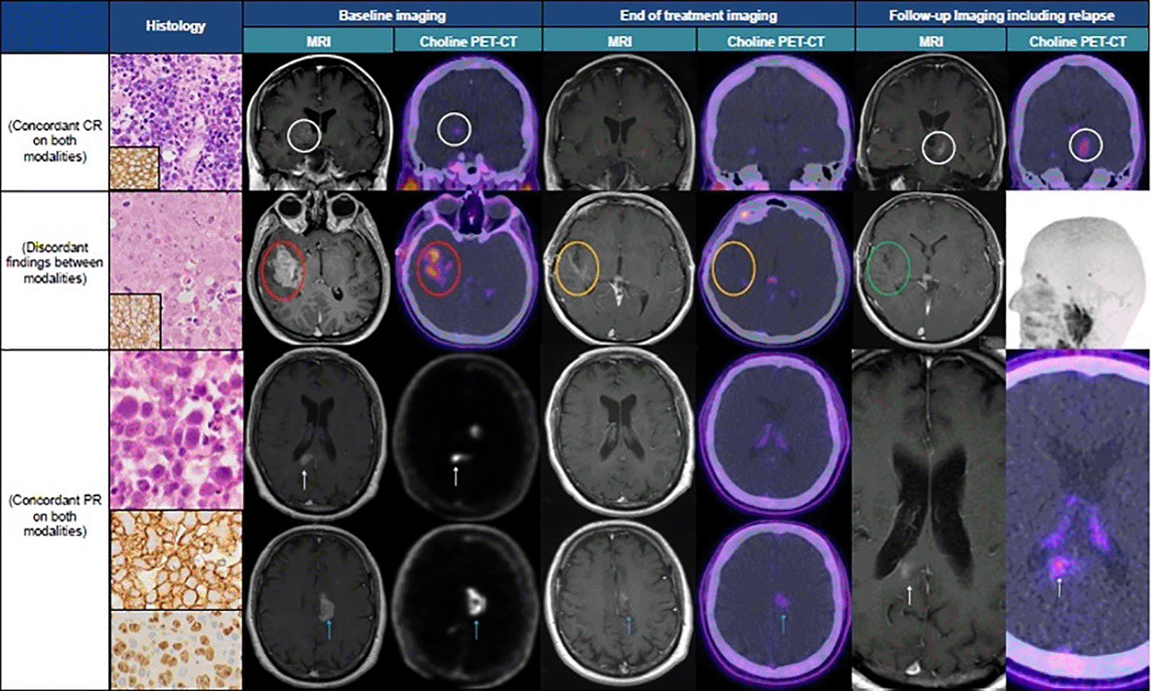[18F]Fluoromethylcholine PET/CT for CNS lymphoma... | F1000Research