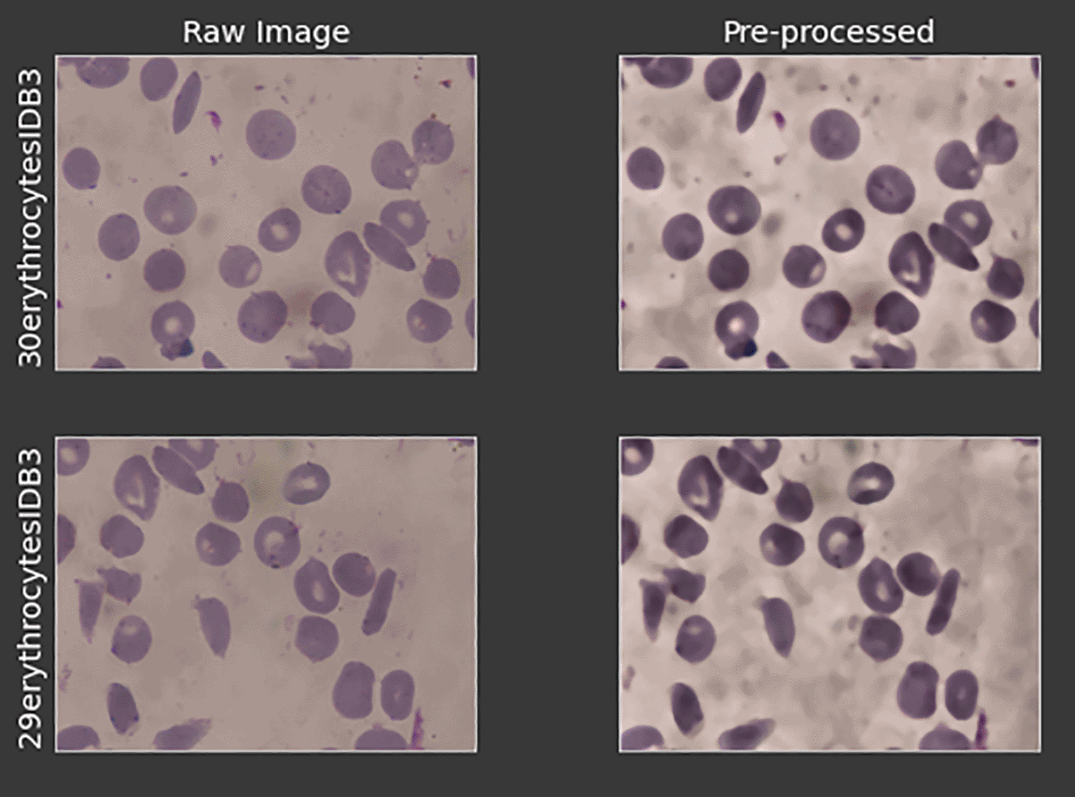Sickle cell segmentation and classification for... | F1000Research
