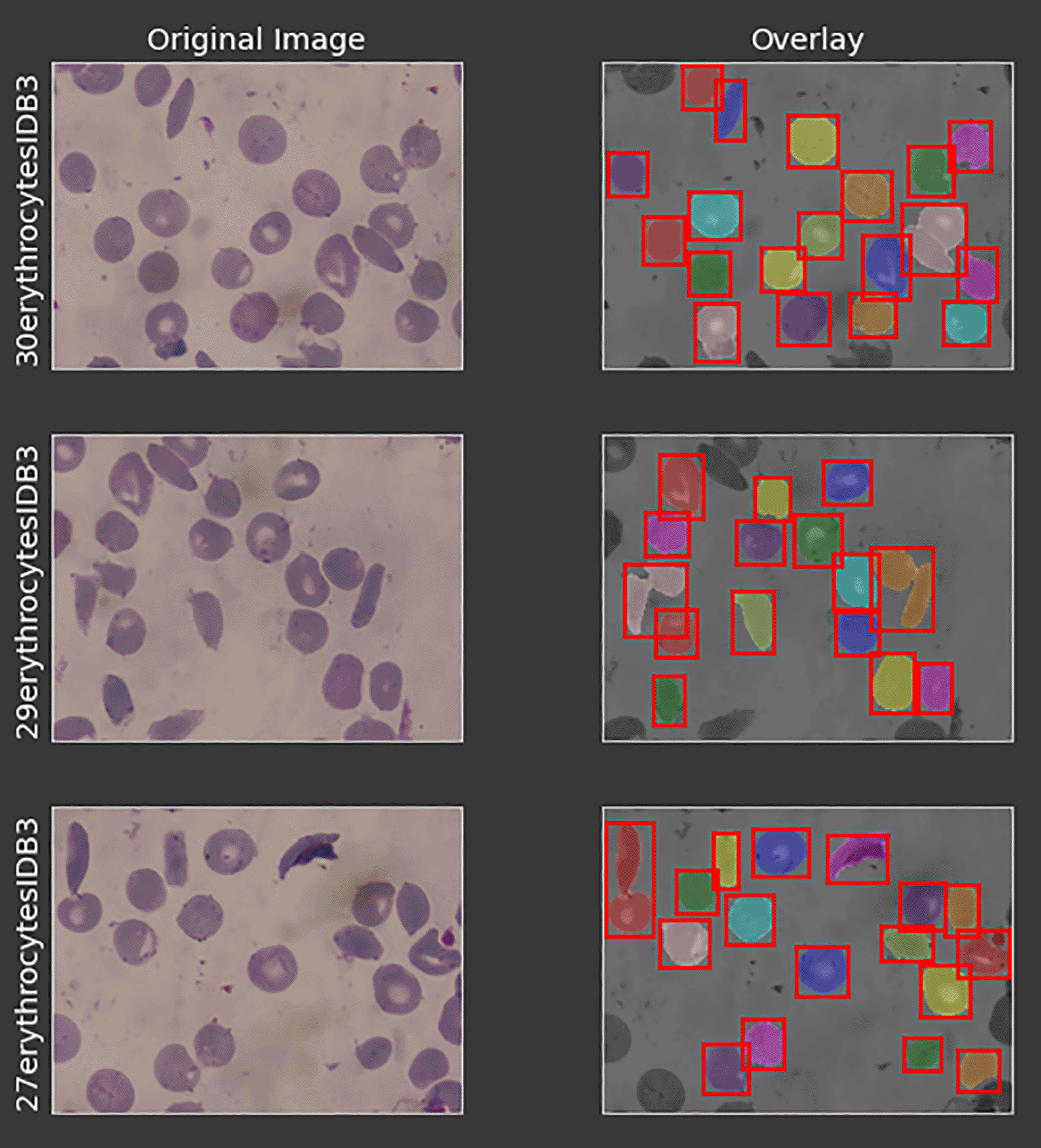 Sickle cell segmentation and classification for... | F1000Research