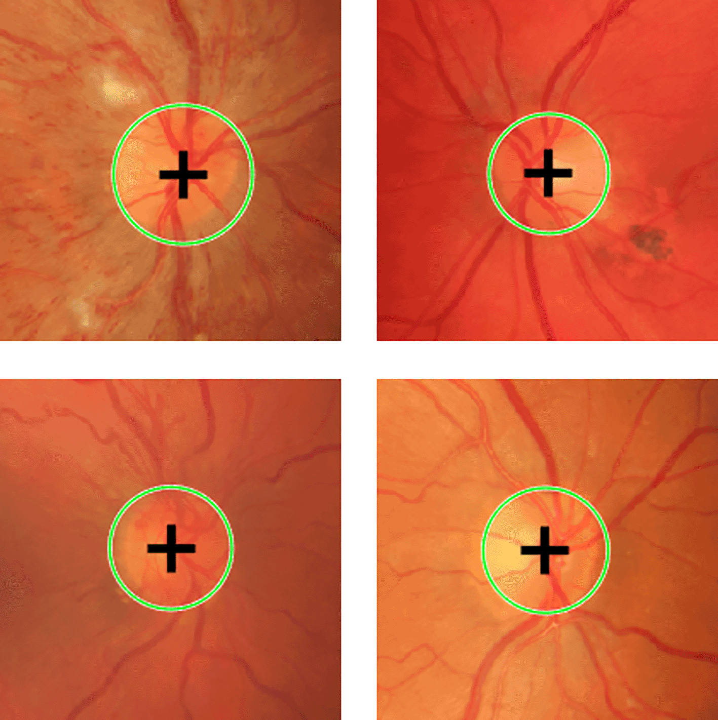 Vessel masking and Hough transform for optic disc... | F1000Research