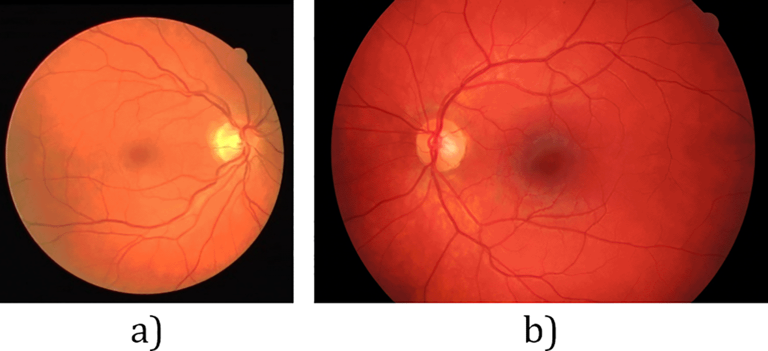 Improved retinal vessel segmentation using the... | F1000Research