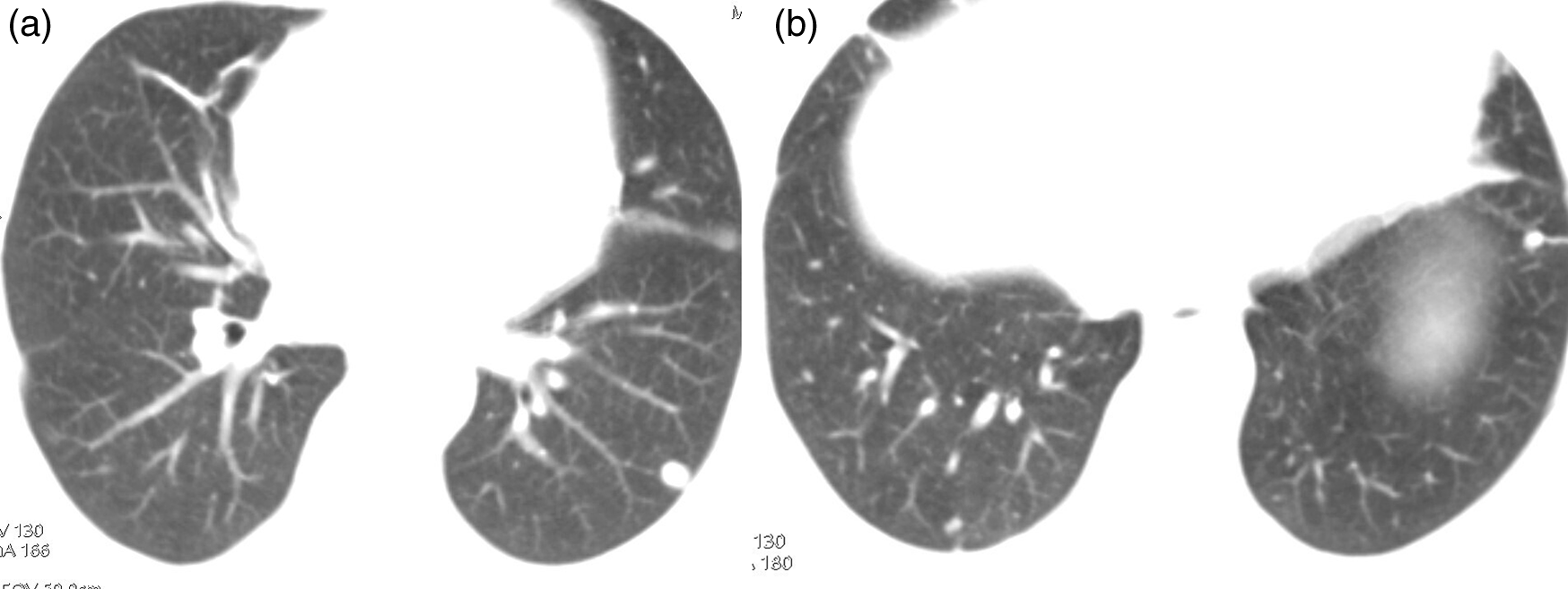 Case Report: Acute abdomen presentation revealing a... | F1000Research