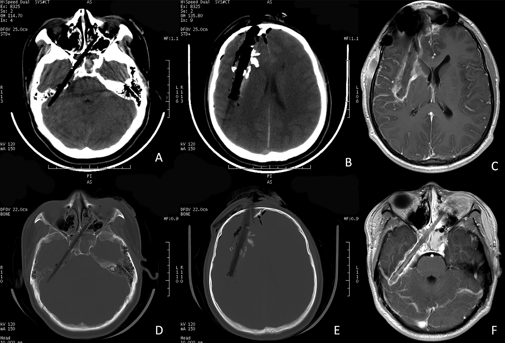 Case Report: Transorbital approach for the... | F1000Research