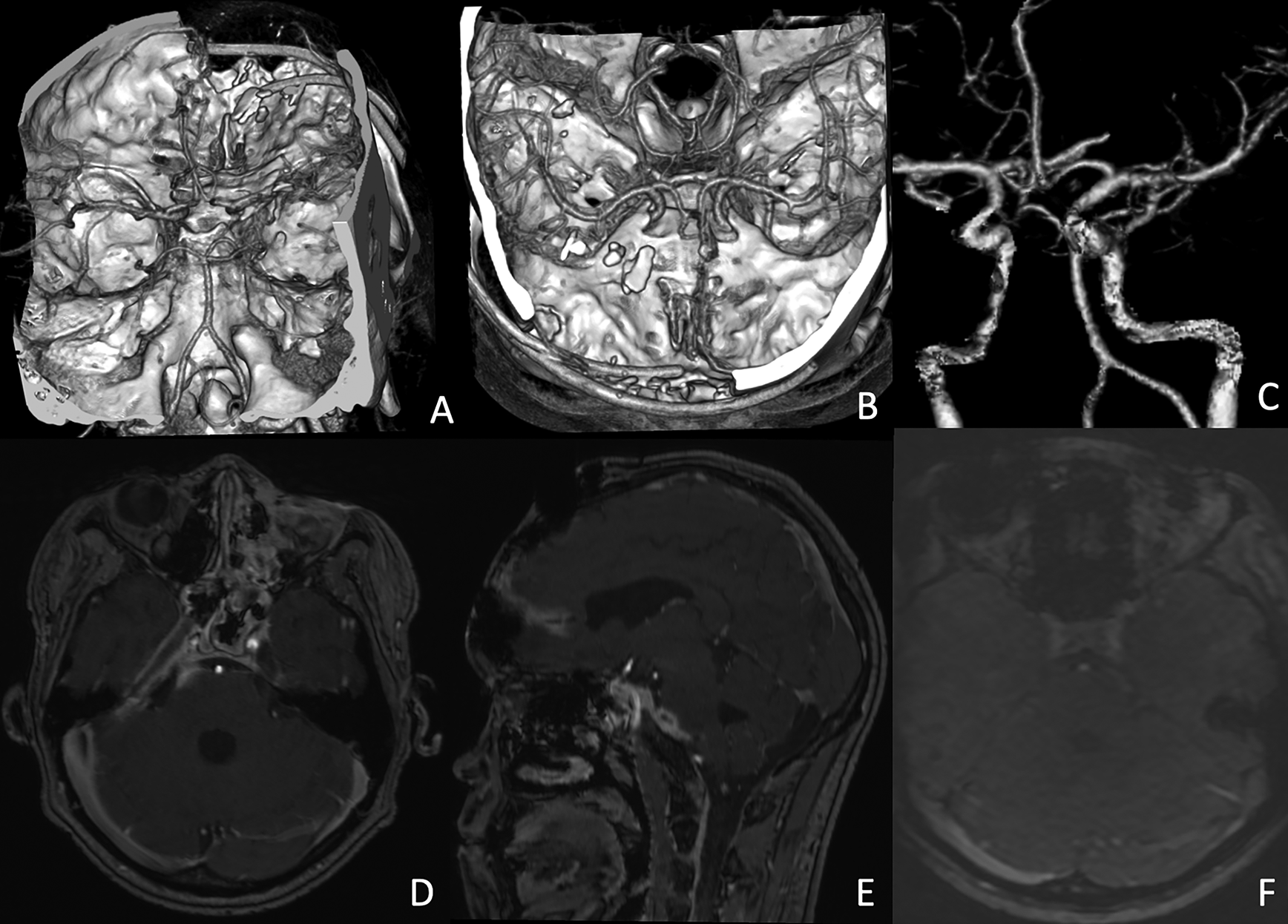 Case Report: Transorbital approach for the... | F1000Research