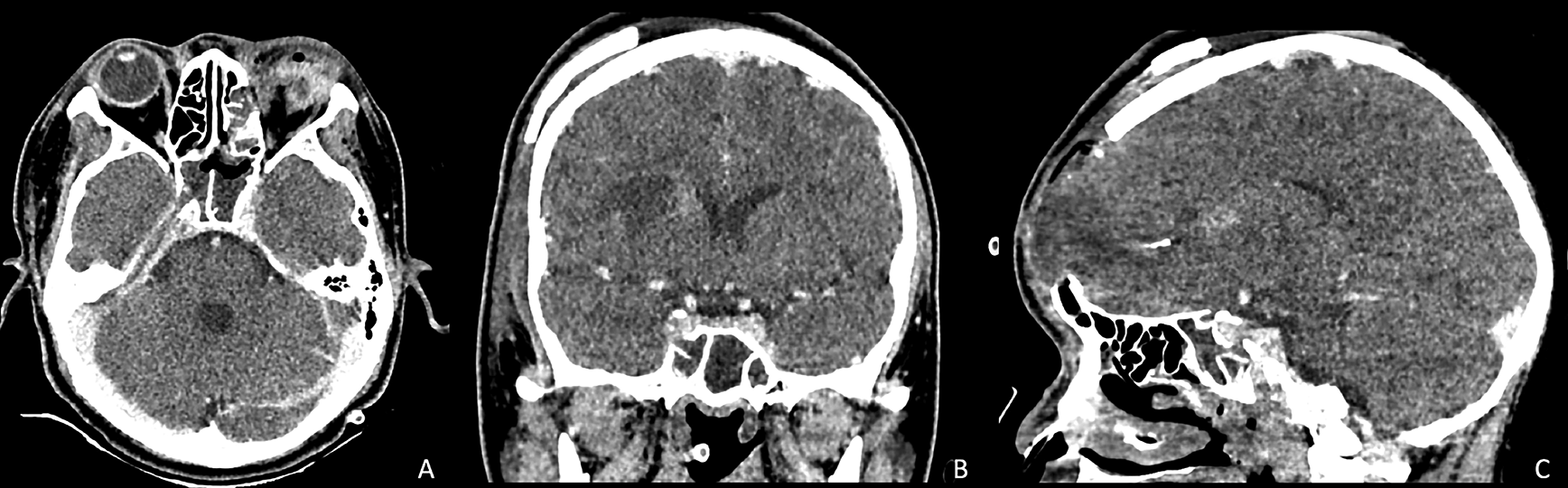 Case Report: Transorbital approach for the... | F1000Research