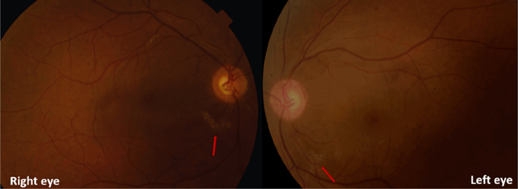Case Report: Purtscher-like retinopathy in a... | F1000Research
