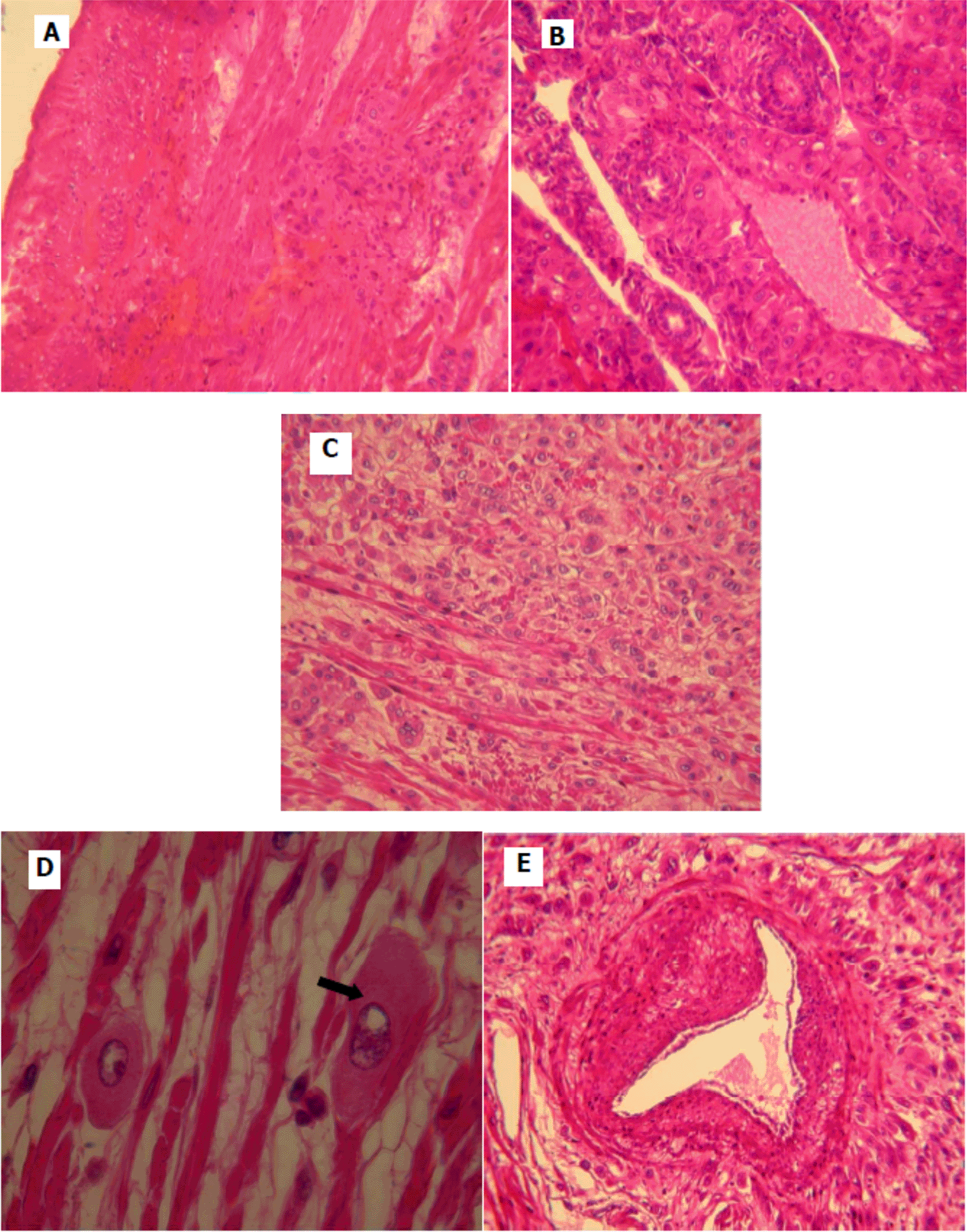 Case Report: Placental site trophoblastic tumor... | F1000Research