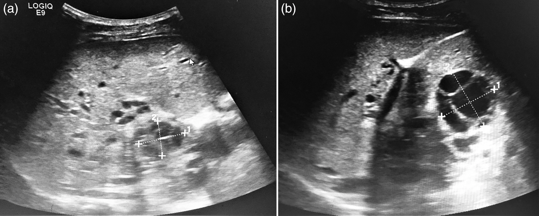 Case Report: Portal cavernoma related to multiple... | F1000Research